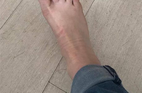 Comment soulager le mal de pieds à cause des talons