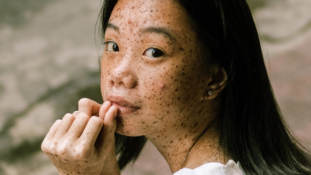 Comment reconnaitre les boutons sur le visage ? Guide des points noirs ...