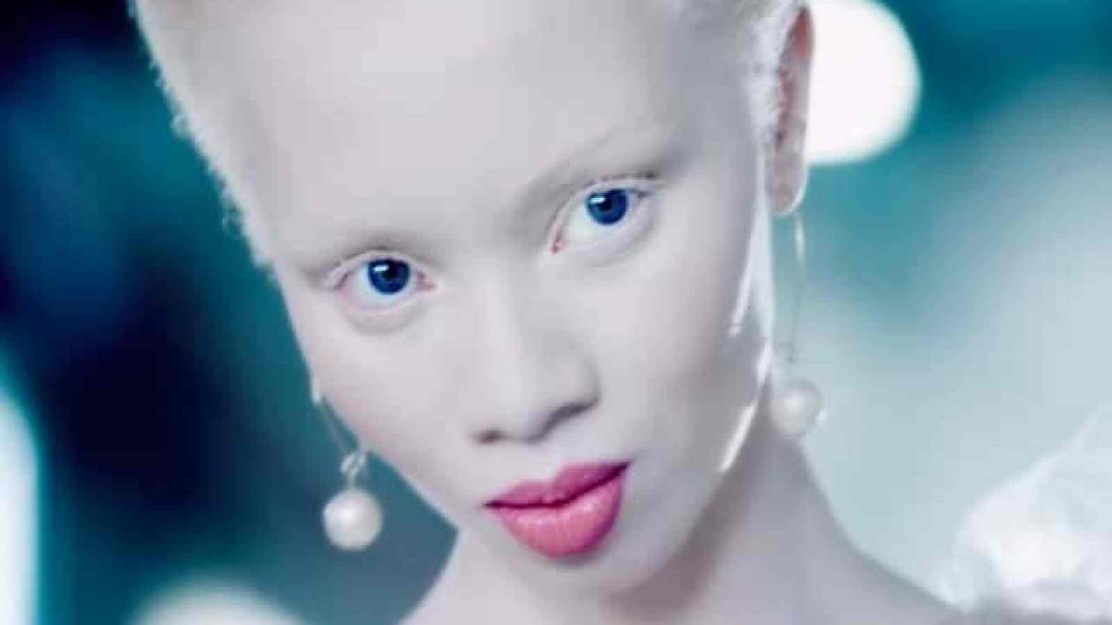 Être albinos en 2018, journée mondiale de l'albinisme